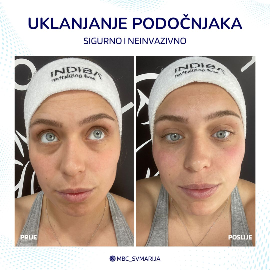 Uklanjanje podočnjaka i bora • Cijena | Rezultati